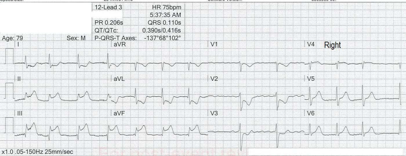 Inferior Wall, Posterior Wall, and Right Ventricular M.I. | ECG Guru ... Inferior Wall, Posterior Wall, and Right Ventricular M.I. | ECG Guru ...